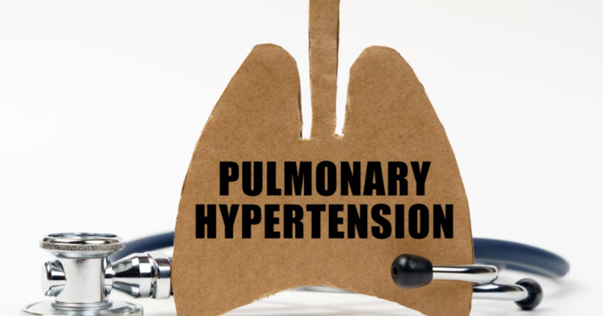 De nieuwe 2022 ESC/ERS-guidelines voor pulmonale hypertensie en hun ...
