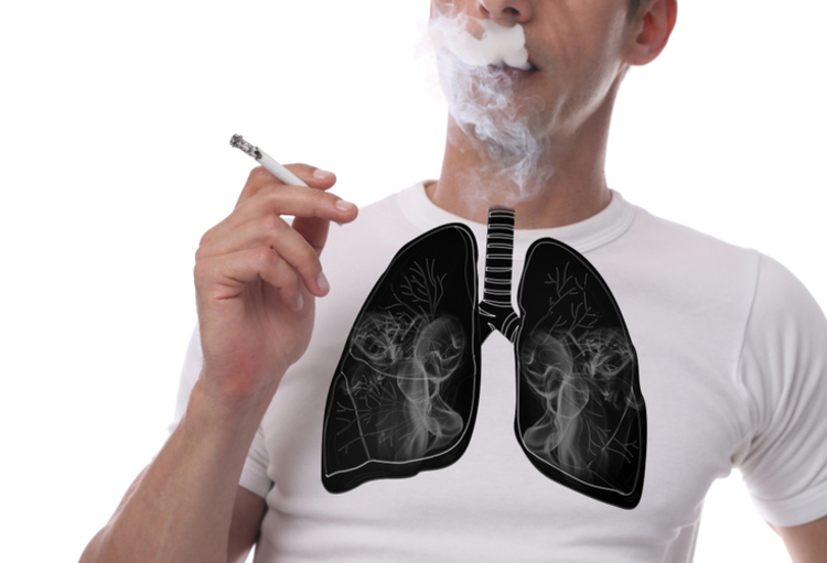 Le tabagisme à l'origine de huit cas de cancer du poumon sur dix - Le ...