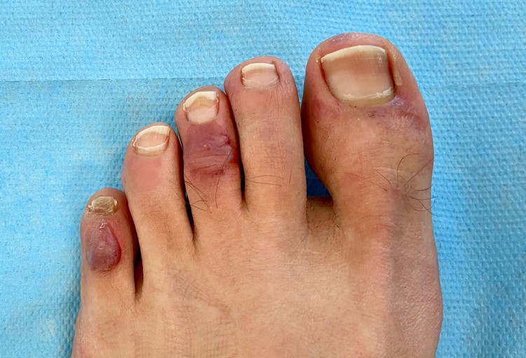 Les engelures seraient plutôt un effet du confinement qu'un signe de ...