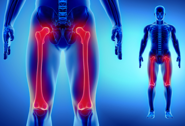 Hoe groot is het fractuurrisico na een atypische femurfractuur? - Ortho ...