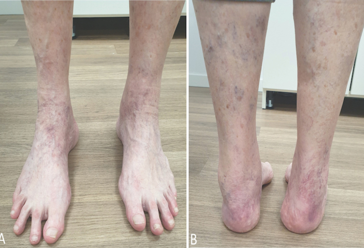 Hypertrophie de la trochlée fibulaire avec ténosynovite des tendons ...