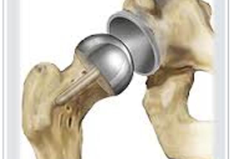 CM 'objectiveert' verschillen heupoperaties - De Specialist