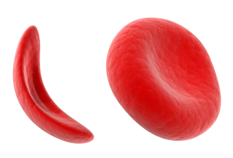 Crizanlizumab en pijnpreventie bij sikkelcelziekte - OncoHemato