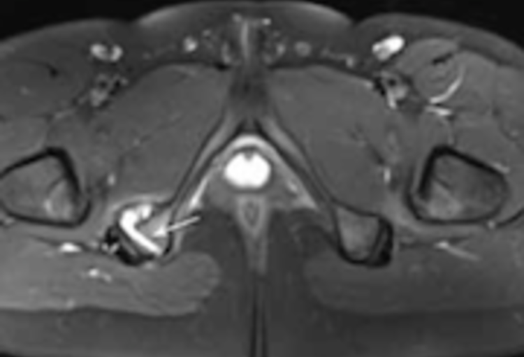 Douleur à la pression sur la tubérosité ischiatique chez un jeune ...
