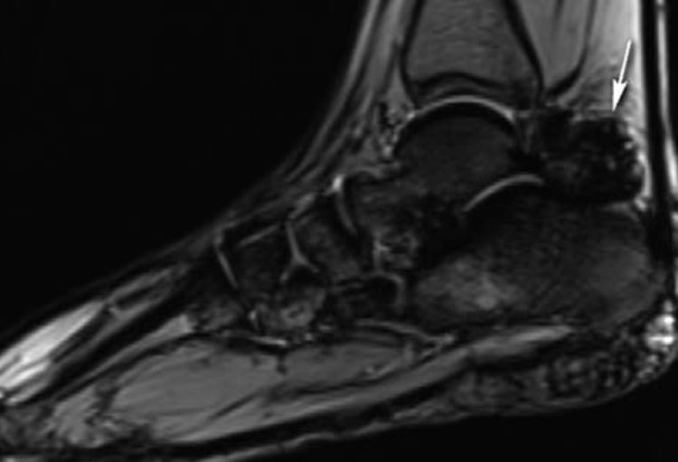 Een ongewone zwelling aan het enkelgewricht - Ortho-Rhumato