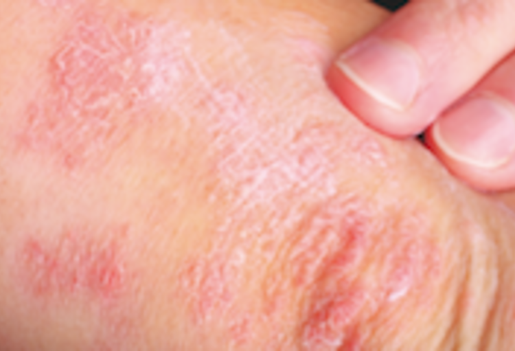 Psoriasis: un nouveau traitement prouve son efficacité - Pharma-Sphere