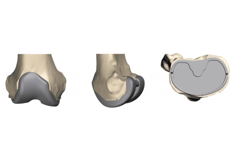 Nieuwe techniek knieprothese op maat doet prothese natuurlijker ...