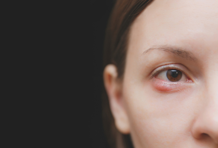 Blefaritis: wat is dat? - Farma-Sfeer