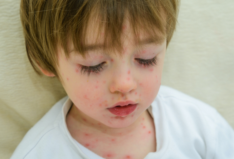 Kinderen met windpokken mogen voortaan toch naar school - De Specialist