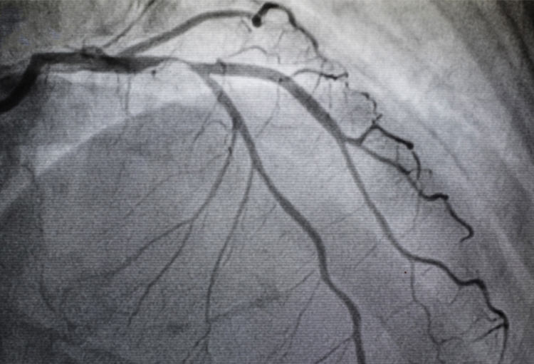 Coronarografie: gericht voor te schrijven - Medi-Sfeer