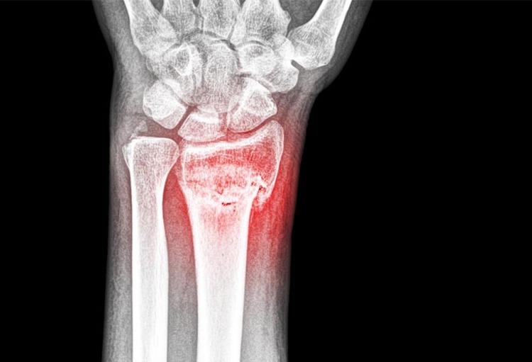Complications associées au traitement des fractures de l’extrémité ...