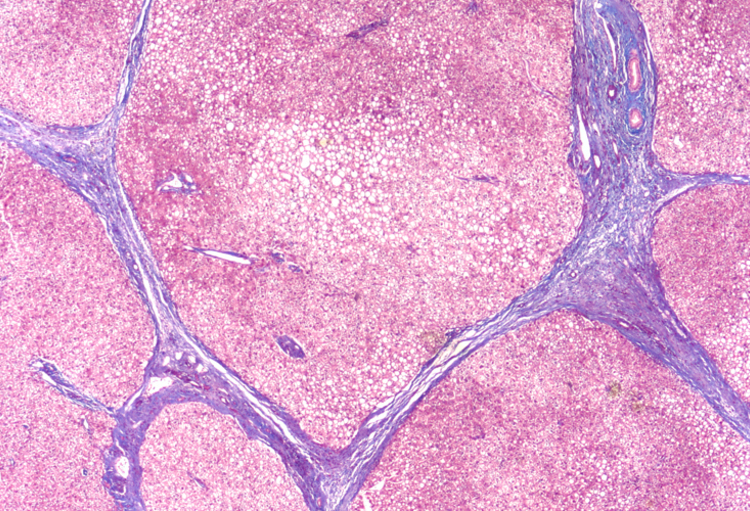 Fibrose hépatique: une approche cellulaire dans la recherche de ...