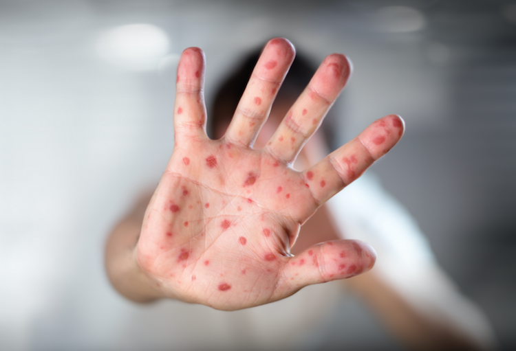 "Mazelen nog gevaarlijker dan gedacht" (internationaal onderzoek ...