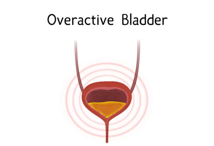 Percutane stimulatie van de nervus tibialis bij een refractaire ...