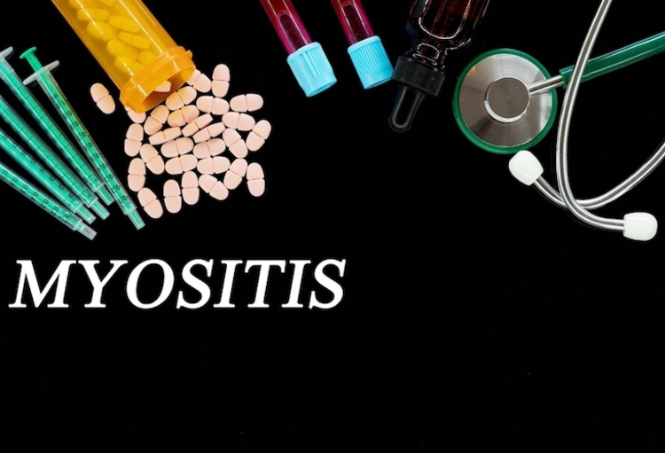 Les anticorps associés à la myosite prédisent un grade de maladie plus ...