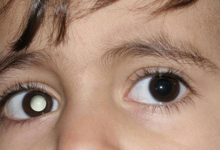 Garder un œil sur les pupilles blanches - Medi-Sphere