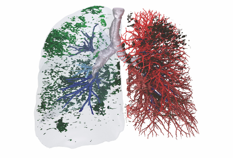 IPF: quantitatieve CT-analyse met functionele beeldvorming superieur ...
